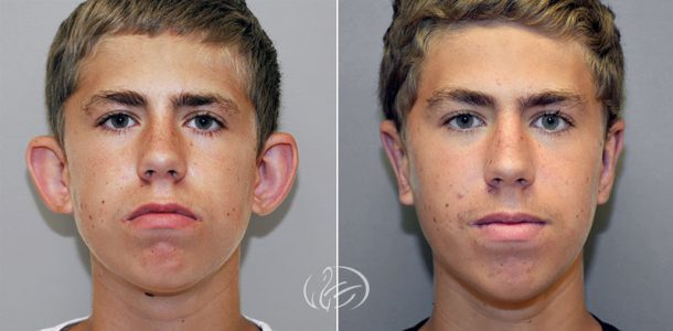 Ear Pinning - Algonquin Plastic Surgeon | Dr. Gunnar Thors